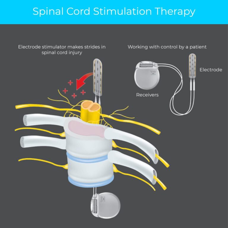 Medtronic Inceptiv Spinal Cord Stimulator A Deep Dive | DrudgePost